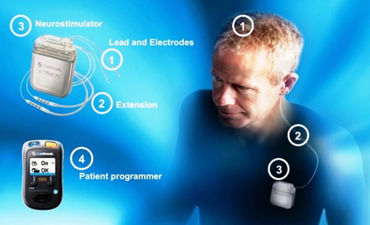 Deep Brain Stimulator implant, the best neurologist in Iran, accommodation