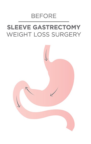 Gastric Sleeve surgery, the best surgeons with accompany, hotel